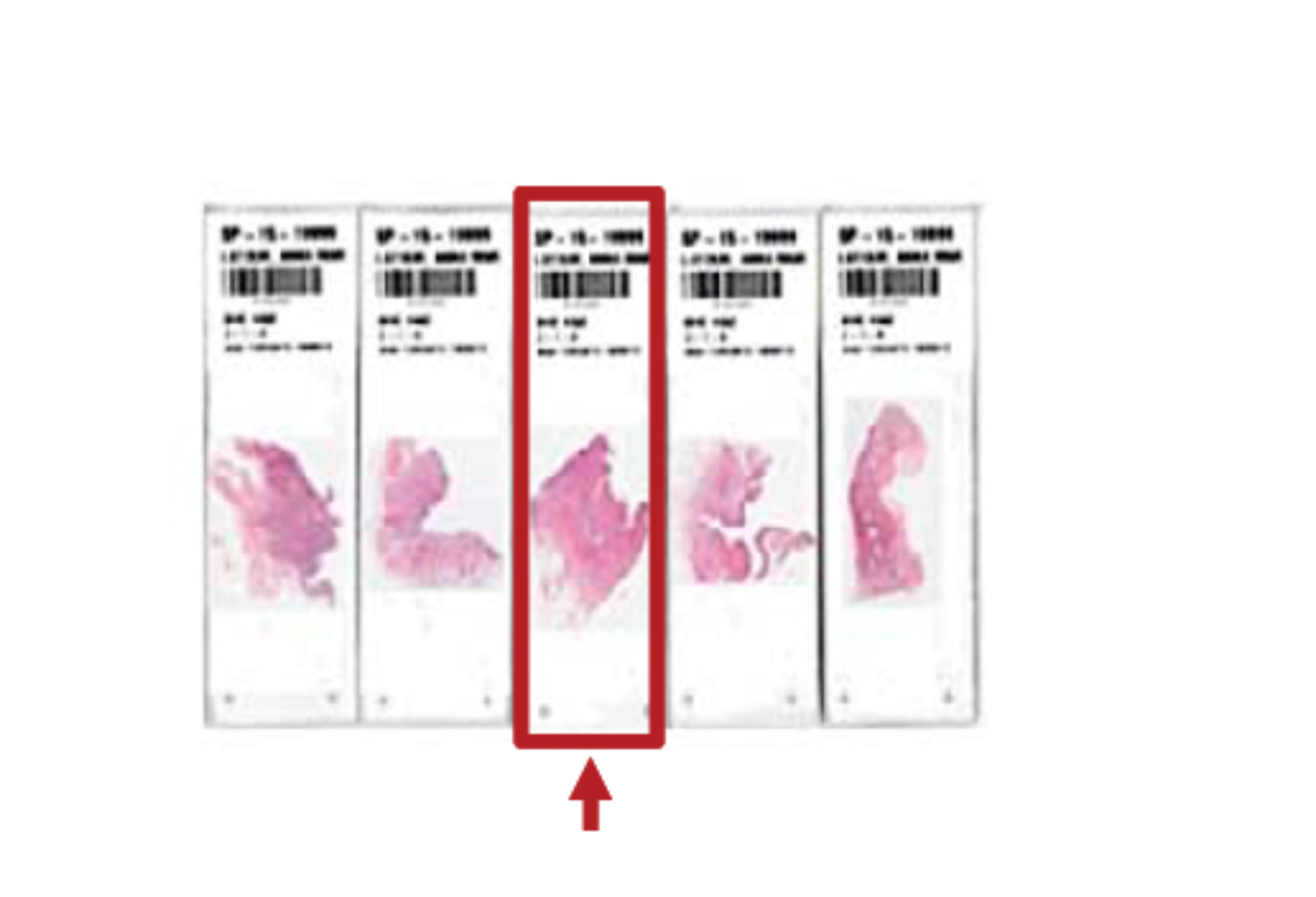 结直肠癌肿瘤出芽病理学评估 - 学习笔记-FZBL.TOP