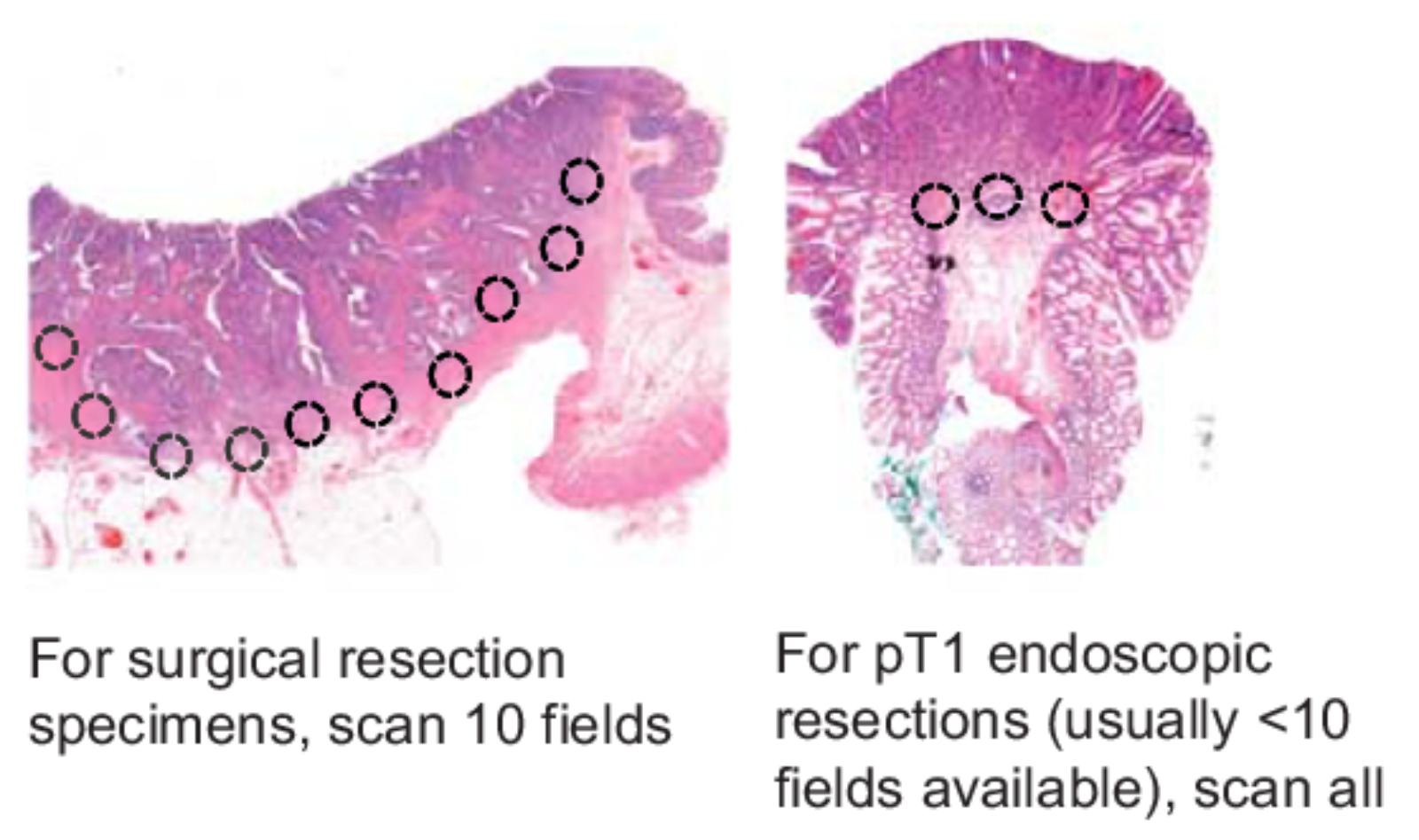 结直肠癌肿瘤出芽病理学评估 - 学习笔记-FZBL.TOP