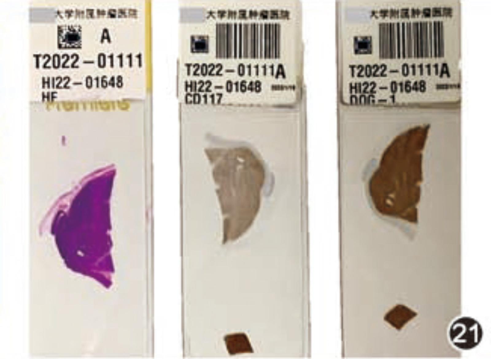 胃肠间质瘤病理诊断临床实践指南（2022版） - 学习笔记-FZBL.TOP