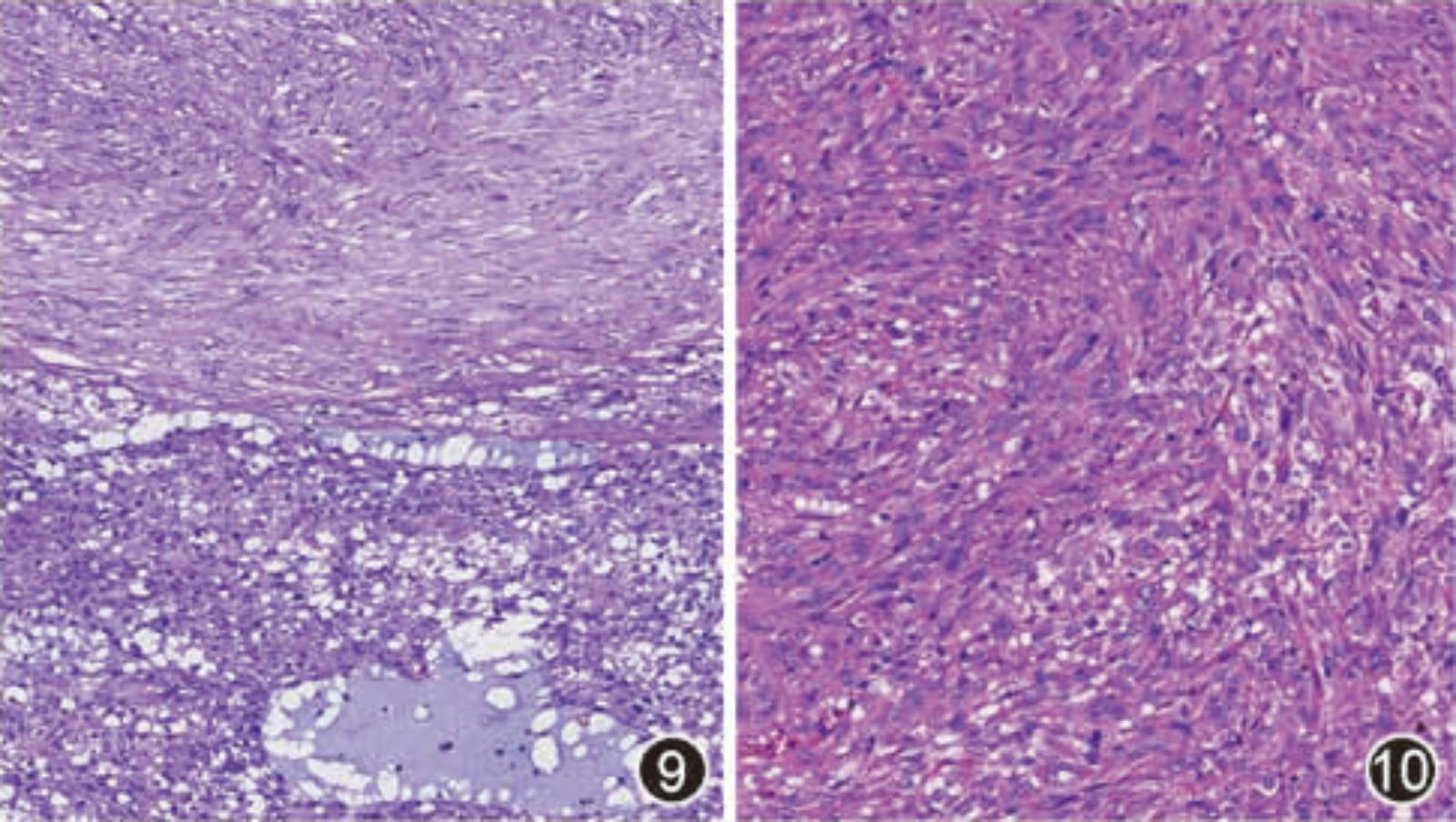 胃肠间质瘤病理诊断临床实践指南（2022版） - 学习笔记-FZBL.TOP